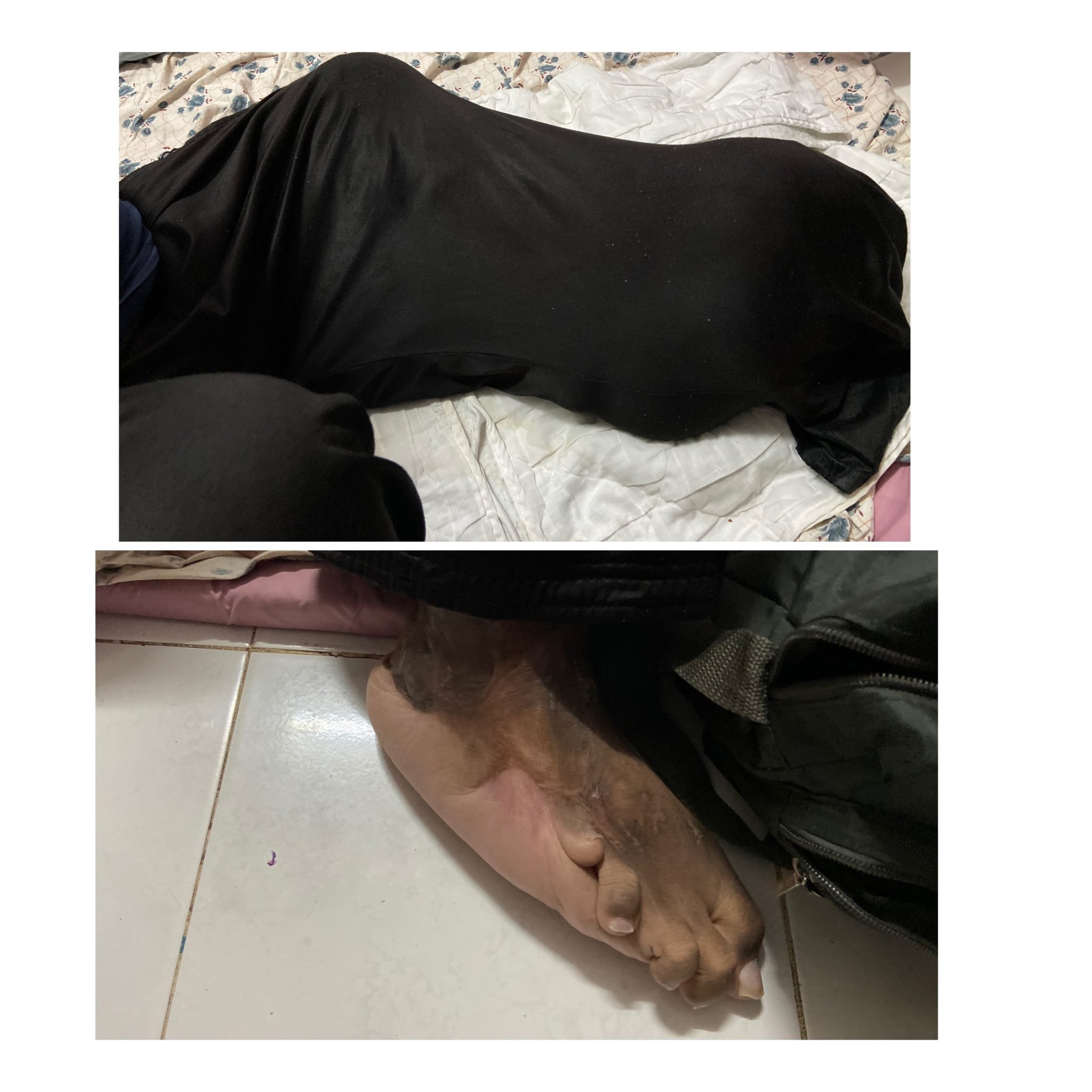 The suffering of a man with Elephantiasis who can’t walk - RAY OF HOPE